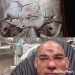 Cris Cyborg posts photo of ex-husband's fractured skull